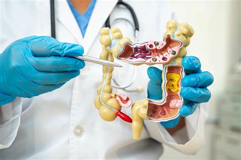 궤양성 대장염 장 맹장 및 소화 시스템 병원에서 연구 진단 및 치료를 위한 해부학 모델을 들고 있는 의사 간 내부 기관에 대한 스톡 사진 및 기타 이미지 Istock