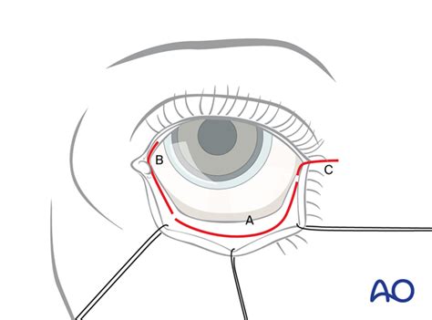 Orif 3 Point Fixation With Orbital Reconstruction For Zygoma Zygomatic Complex Fracture