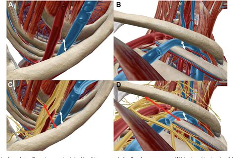Figure 10 From Pectoralis Minor Syndrome E Review Of Pathoanatomy Diagnosis And Management Of