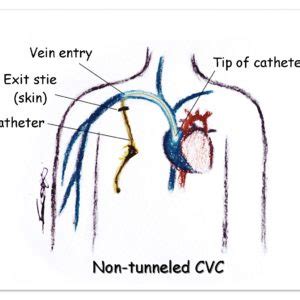 Types Of Central Venous Catheters Cvc The Scrub Nurse