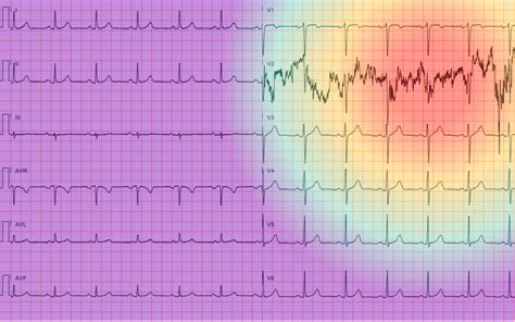 Applying Explainable Ai Algorithms To Healthcare ΑΙhub