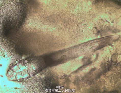 毛囊虫皮炎1例 医联