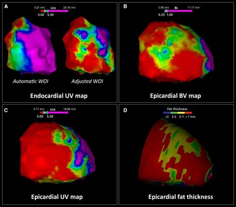 Unipolar Voltage Mapping In Right Ventricular Cardiomyopathy Pitfalls Solutions And Advantages