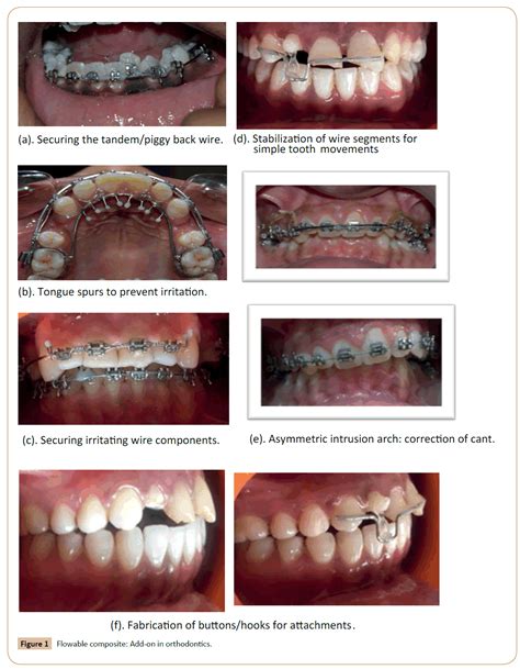 Flowable Composite Add On In Orthodontics Insight Medical Publishing