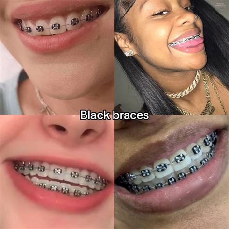 Ghim Trên Braces For Me Trong 2024
