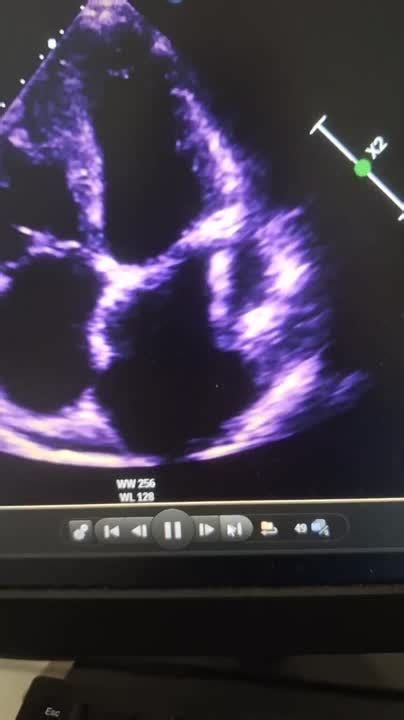 Hanadi Sakota On Linkedin Severe Ms Laa Thrombus Echo Rhd