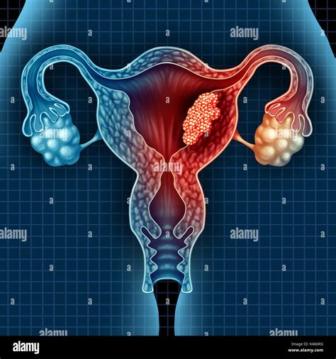 Uterus Cancer And Endometrial Malignant Tumor As A Uterine Medical