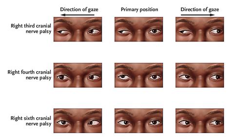 Cranial And Ocular Motor Nerve Palsies — Hashemi Eye Care