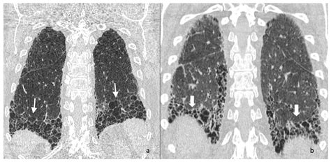 Radiological Insights Into Uip Pattern A Comparison Between Ipf And