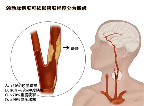 健康科普正确认识颈动脉斑块科学管理有效防范 血液 患者 血管