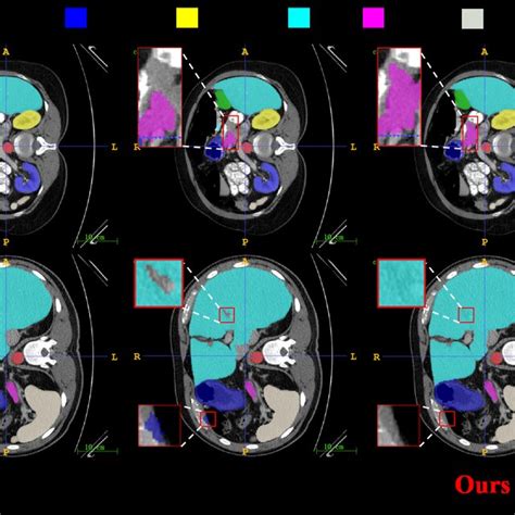 The Visualization Comparison On The Synapse Dataset Download