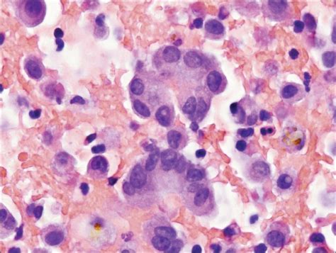 Hepatocellular Carcinoma Cytology