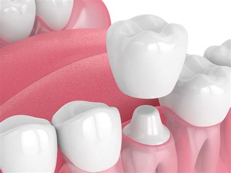 Crowns Carntyne Dental Care Glasgow