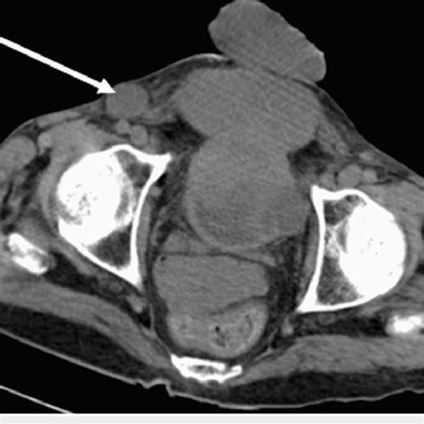 Clinical Image Of Fungating Tumor After Taking Wedge Biopsy From It Download Scientific Diagram