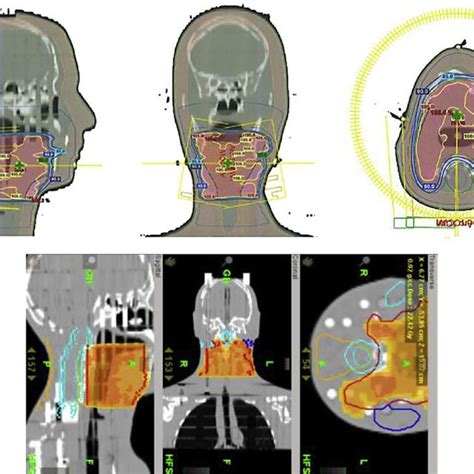 Pdf Peripheral Doses In Radiotherapy A Comparison Between Imrt Vmat And Tomotherapy