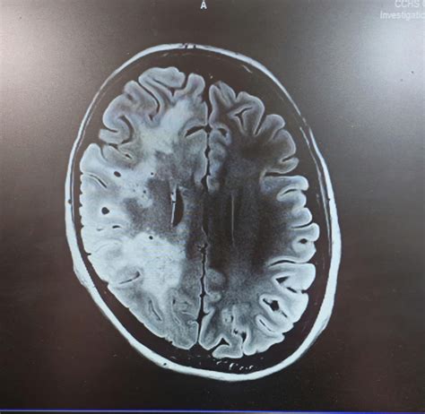 Mri Abnormal Brain Scan Dr Balaji Anvekars Neuroradiology Cases