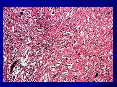 Soft Tissue Tumors 2012 Ppt