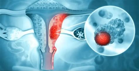 Endometrial Cancer Treatment Cost In India Best Doctors For