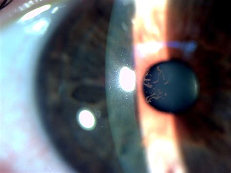 Map Dot Fingerprint Dystrophy Ocular