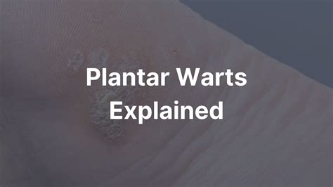 Plantar Warts Explained Manly Cove Podiatry