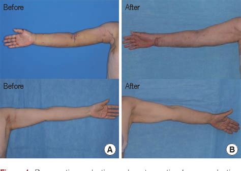 Figure 1 From Vascularized Free Lymph Node Flap Transfer In Advanced