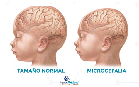 Zika Vírus Microcefalia Sintomas E Tratamentos Saúde Blog Opas