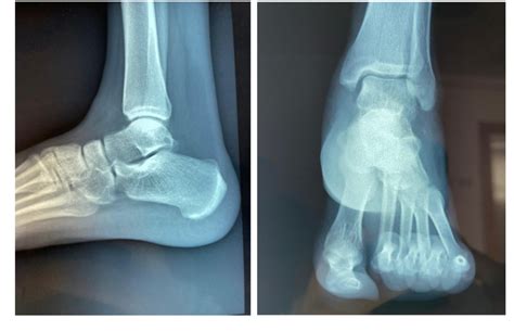 Figure 4 From Closed Medial Subtalar Dislocation A Case Report And Literature Review Semantic