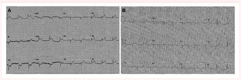 Figure 1 From Simultaneous St Elevation Myocardial Infarction In Monozygotic Twins A Case