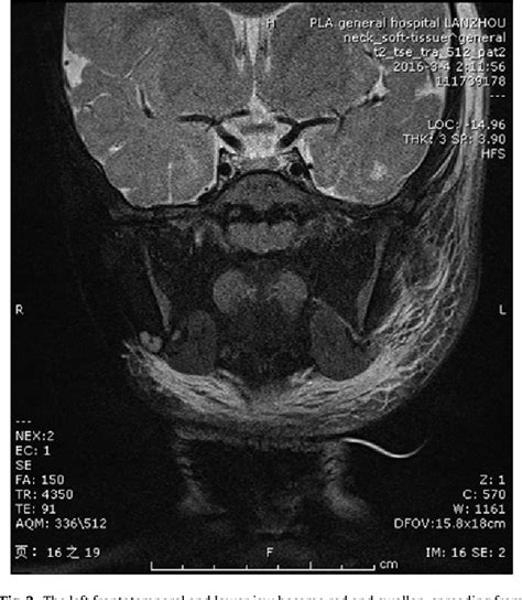 Figure 2 From Postoperation Of Preauricular Fistula Cellulitis Caused