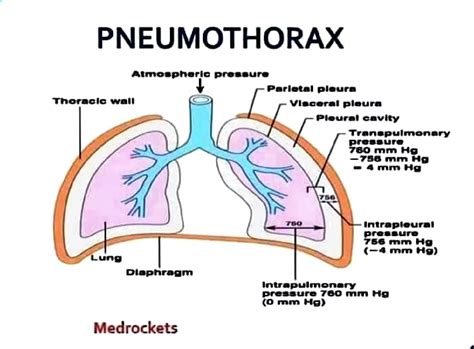 Solution Pneumothorax Notes Study Guide Studypool