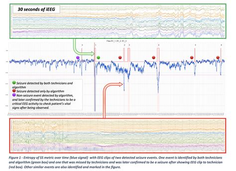 Seizure Detection Using Entropy Of Source Sink Nodal Dynamics In The Epileptic Network