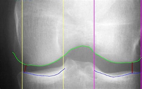 A Digitized Radiograph Analyzed For Minimum Joint Space Width Using An