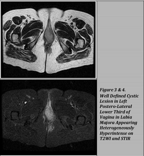 Figure 1 From Infected Bartholin Cyst Ultrasonography Doppler