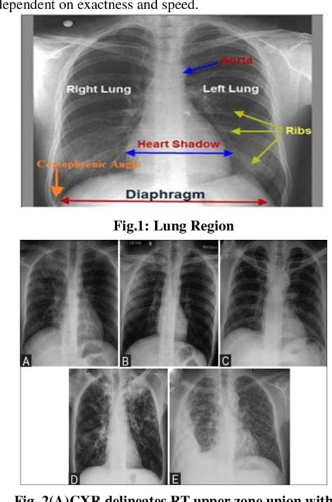 Figure 2 From Automatic Tuberculosis Screening Using Chest Radiographs Semantic Scholar