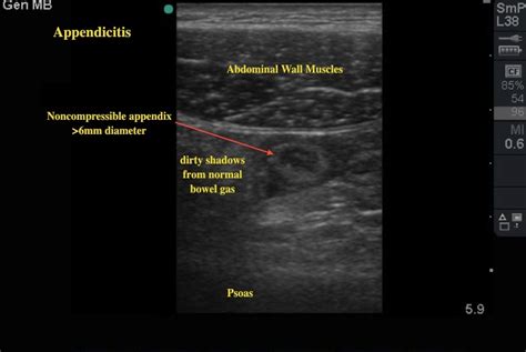 Ultrasound For Appendicitis ~ Ultrasound Cases Info