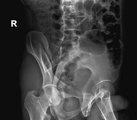 Bucket Handle Fracture