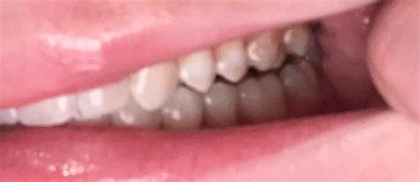 Wisdom Teeth R Invisalign