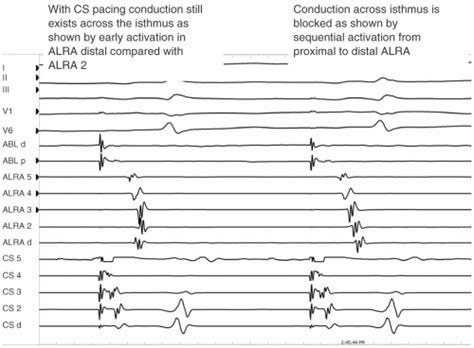 Atrial Flutter Thoracic Key