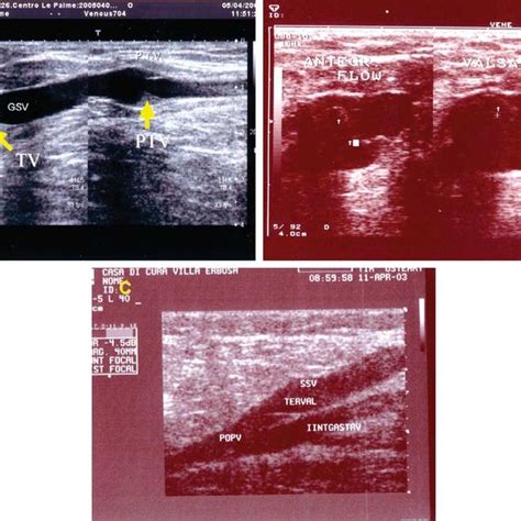 Anterior Accessory Saphenous Vein AASV And The Alignment Sign A Download Scientific