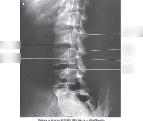 Pos RPO Lumbar Spine Diagram Quizlet