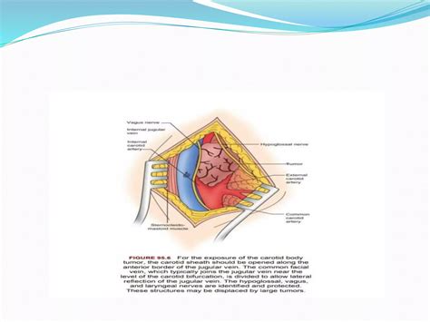 Carotid Body Tumorpptx Heart And Cardiovascular Diseases Diseases And Conditions