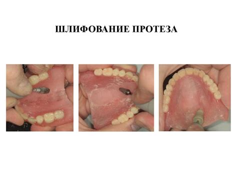 Починка пластиночного протеза презентация онлайн