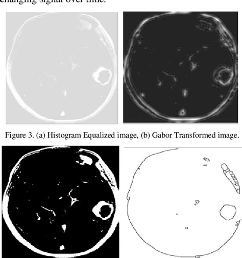 Figure 3 From To Detect Abnormality In Lung Images Using Watershed Segmentation Semantic Scholar