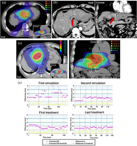 Diagnostic Images And Treatment Plan For Liver Tumour A The Previous Download Scientific