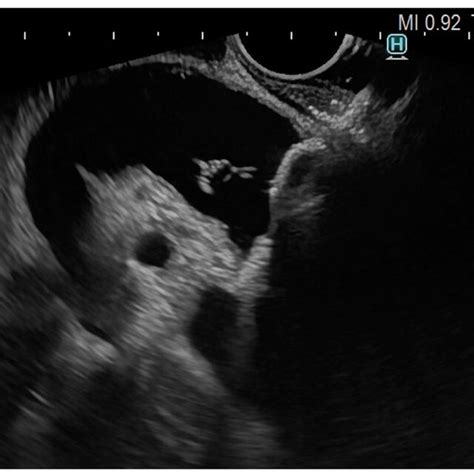 Ec Lams Inside The Cbd Partial Deployment Of Distal Flange Of The