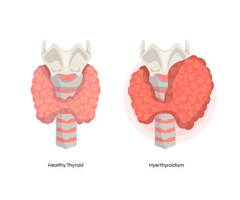 Hyperthyroidism Treatment And Diagnosis Medication Symptoms