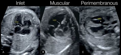 Ventricular Septal Defect Ultrasound