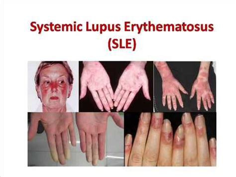 Systemic Lupus Erythematosus