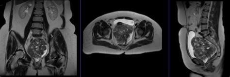 Uterine Fibroid Mri Protocol Fibroid Mapping Mri Protocol And Planning