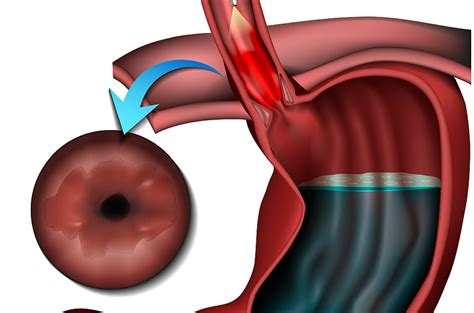 Asge Recommendations For Screening And Surveillance Of Barretts Esophagus Gastroenterology